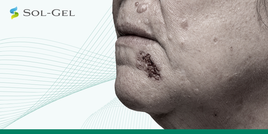 A Pipeline of Advanced Dermatological Drugs | Sol-Gel Technologies